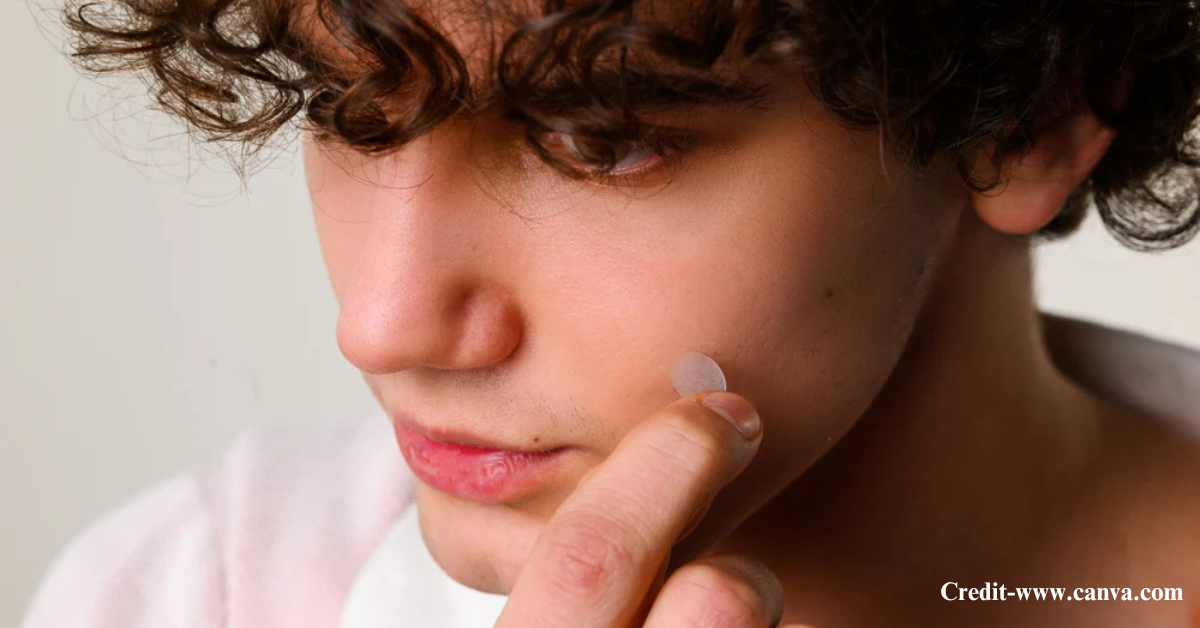 Best Pimple Patches